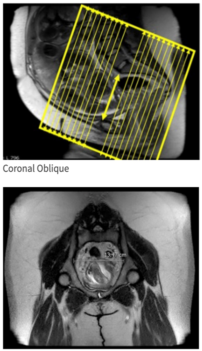 MRI Pelvimetry WO BODY Protocol | OHSU